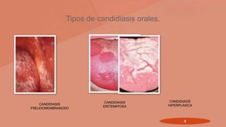 Caracteristicas-Clinicas-de-las-Infecciones-Micoticas.pptx