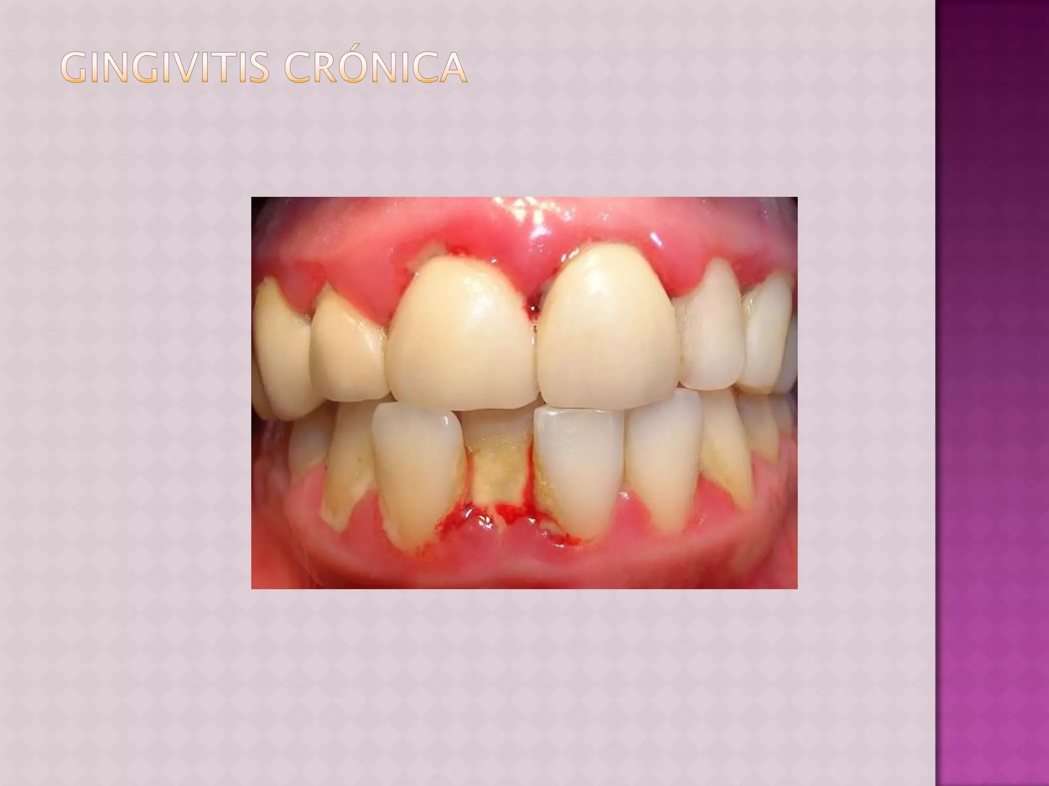 Caracteristicas Clinicas De La Gingivitis | PDF