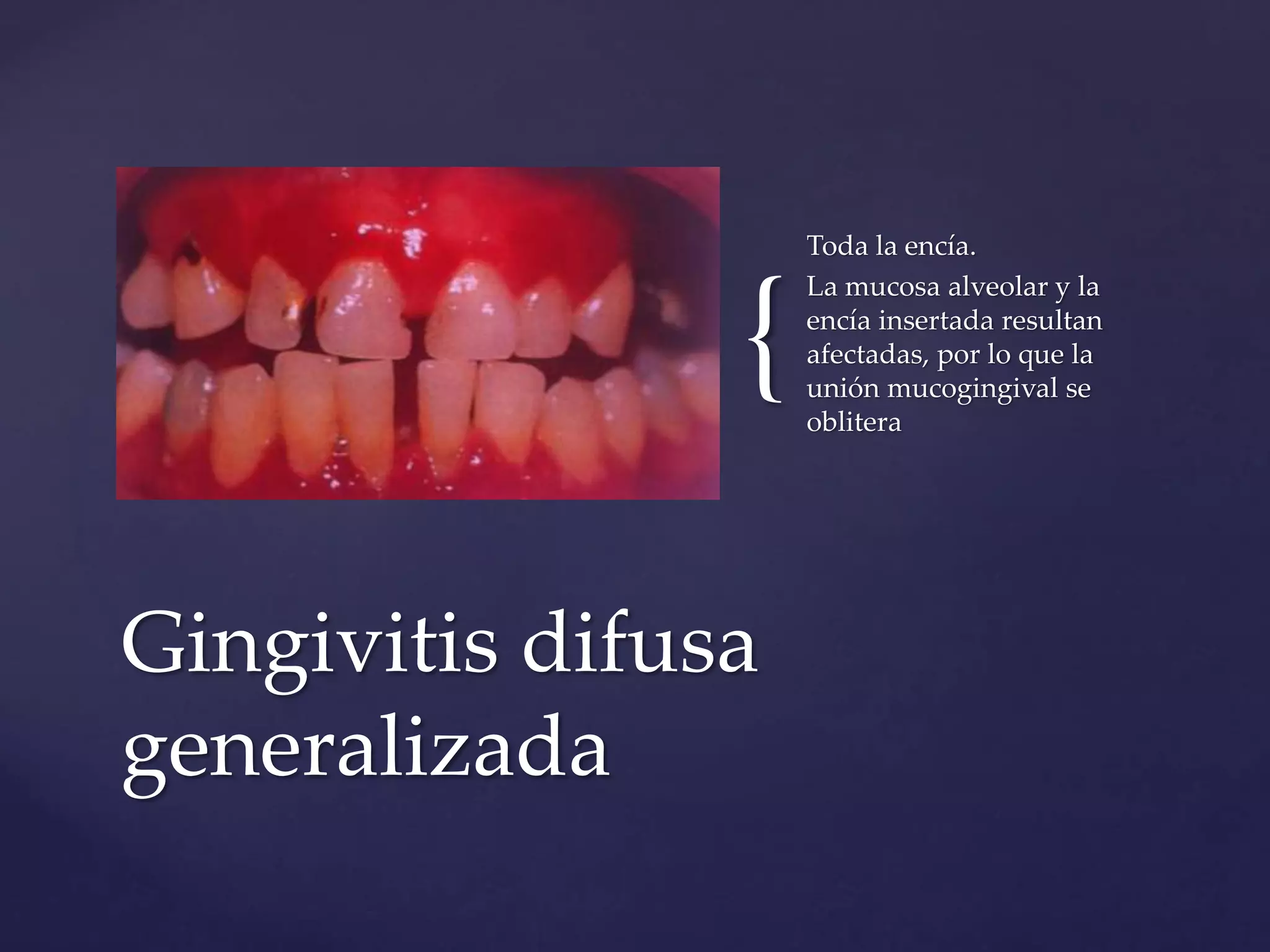 Características clinicas de la gingivitis | PPT | Descarga Gratuita