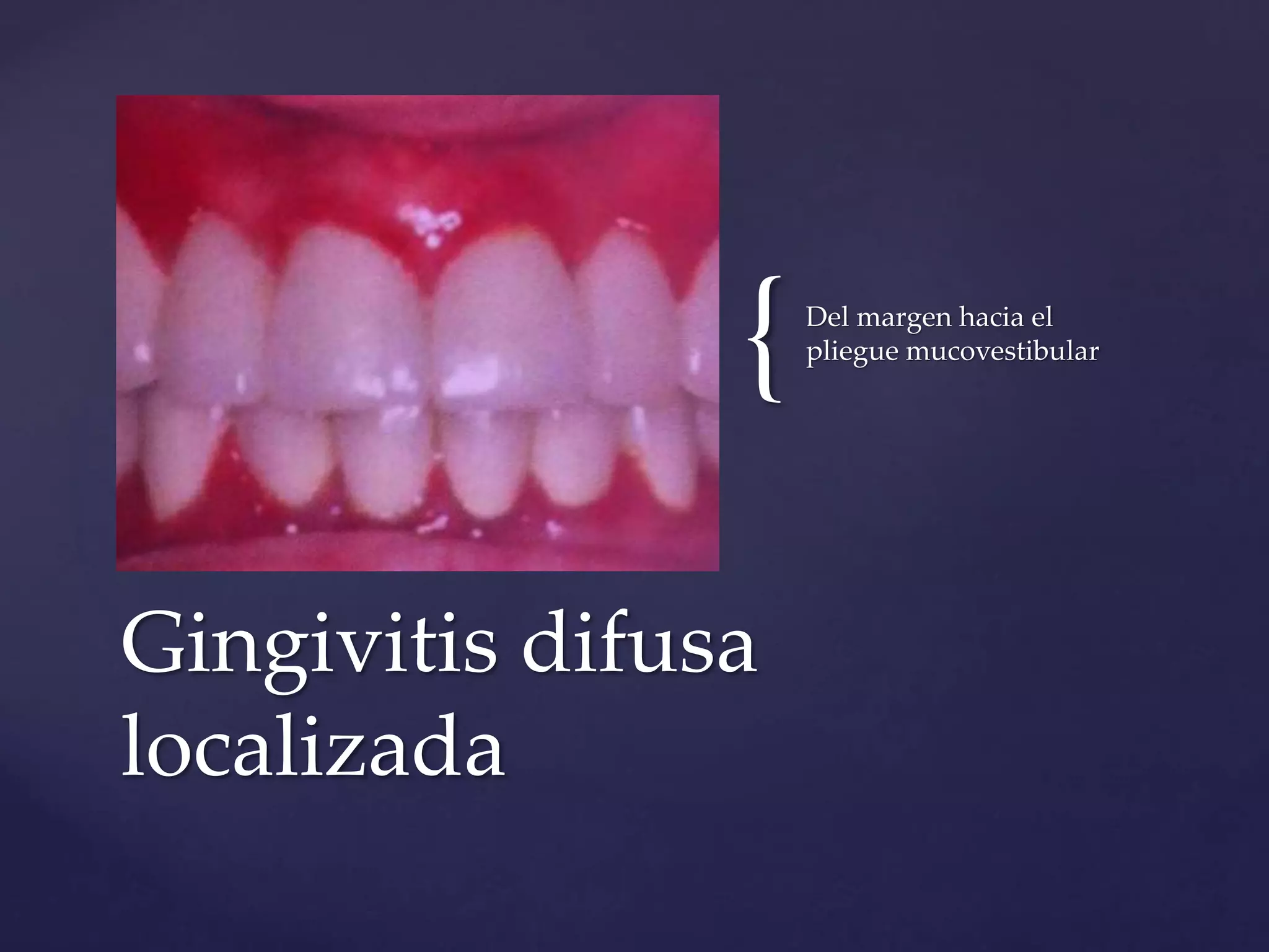 Características clinicas de la gingivitis | PPT