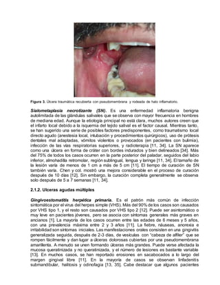 CARACTERISTICAS DIAGNOSTICAS DE LAS LESIONES ULCERATIVAS ORALES COMUNES ...