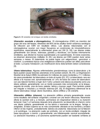 CARACTERISTICAS DIAGNOSTICAS DE LAS LESIONES ULCERATIVAS ORALES COMUNES ...