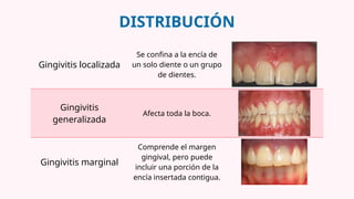 Características clínicas de gingivitis.pptx