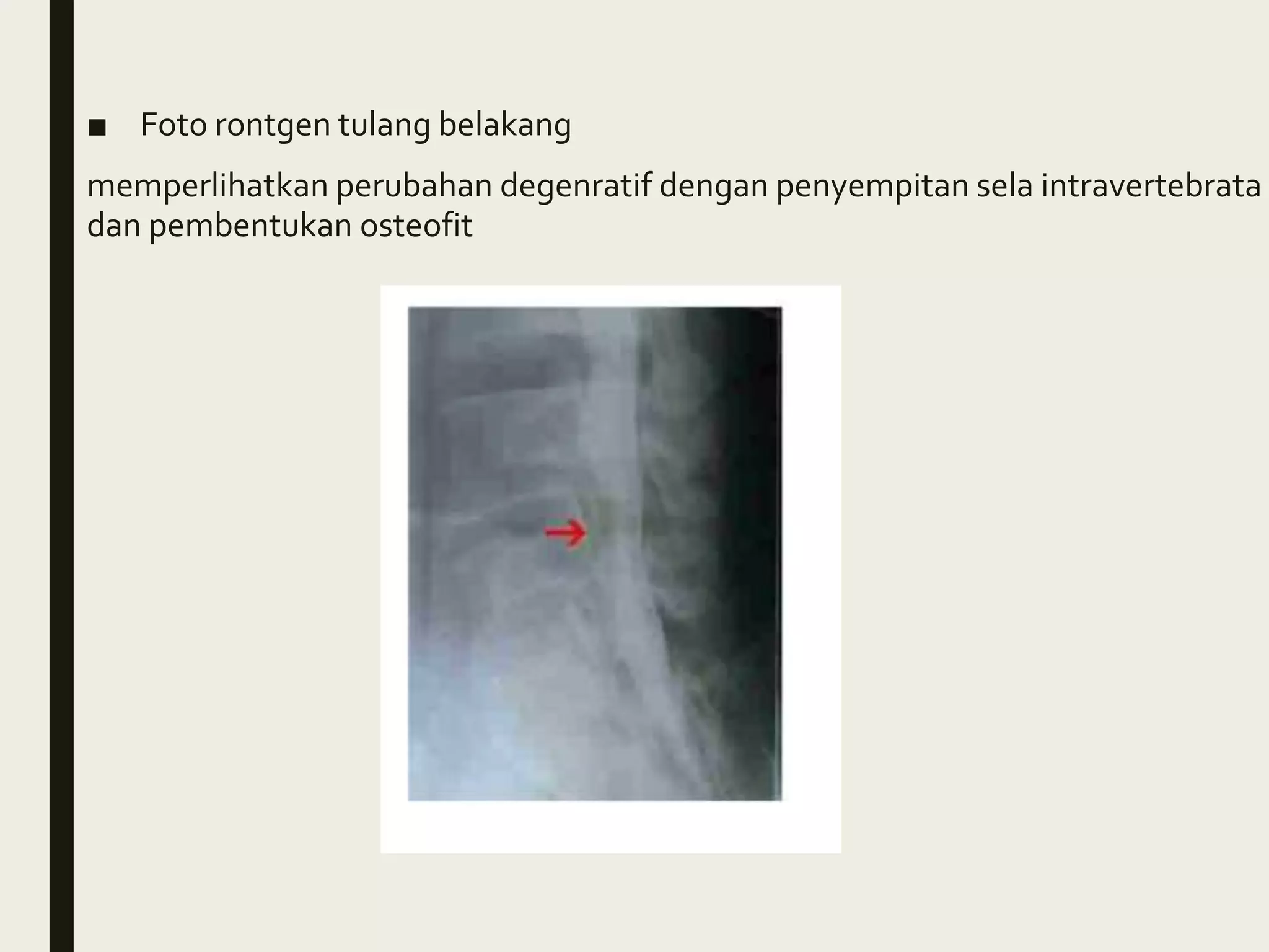 Cara Mediagnosa HNP.pptx