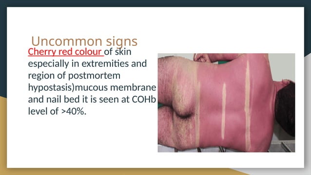 Carbon monoxide poisoning Forensic medicine and toxicology | PPTX