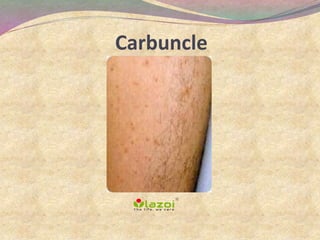 Carbuncle Pictures Diagnosis Causes Treatment How To Treat A Skin