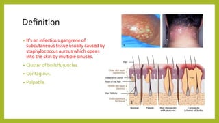 Carbuncle Lecture | PPTX