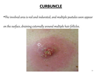 Carbuncle.pptx