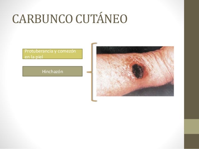 Carbunco o Bacillus Anthracis