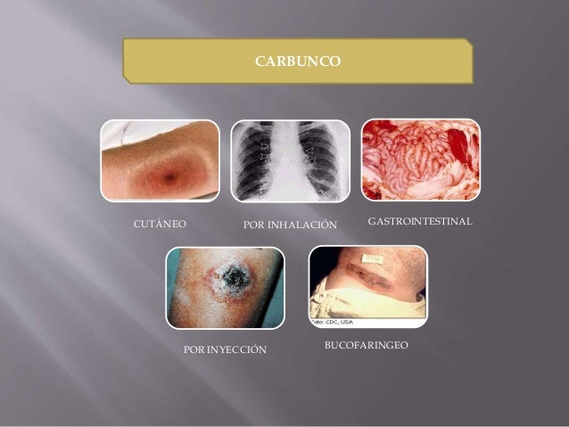 Carbunco: tipos y tratamiento