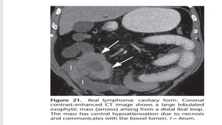Lymphoma and Neuro endocrine tumors of intestine | PPTX