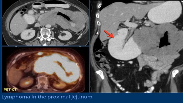 Lymphoma and Neuro endocrine tumors of intestine | PPTX