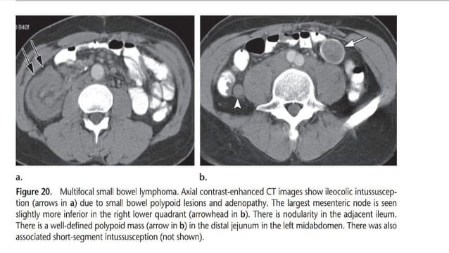 Lymphoma and Neuro endocrine tumors of intestine | PPTX