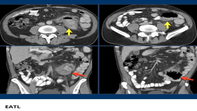 Lymphoma and Neuro endocrine tumors of intestine | PPTX