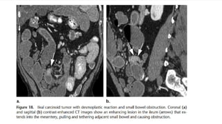 Lymphoma and Neuro endocrine tumors of intestine | PPTX