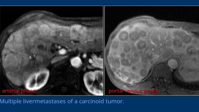 Lymphoma and Neuro endocrine tumors of intestine | PPTX
