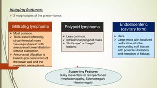 Lymphoma and Neuro endocrine tumors of intestine | PPTX