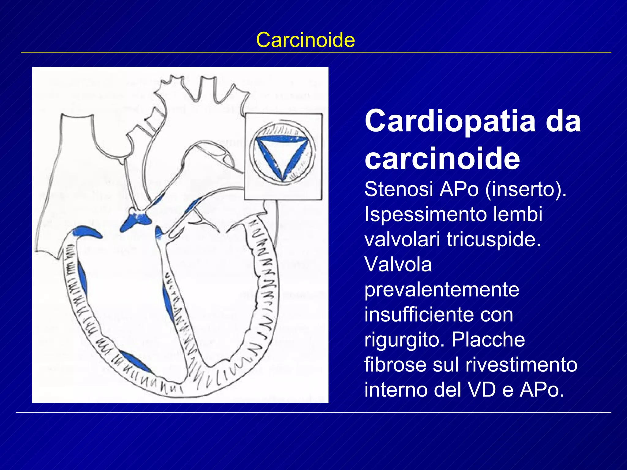 Carcinoide | PPT