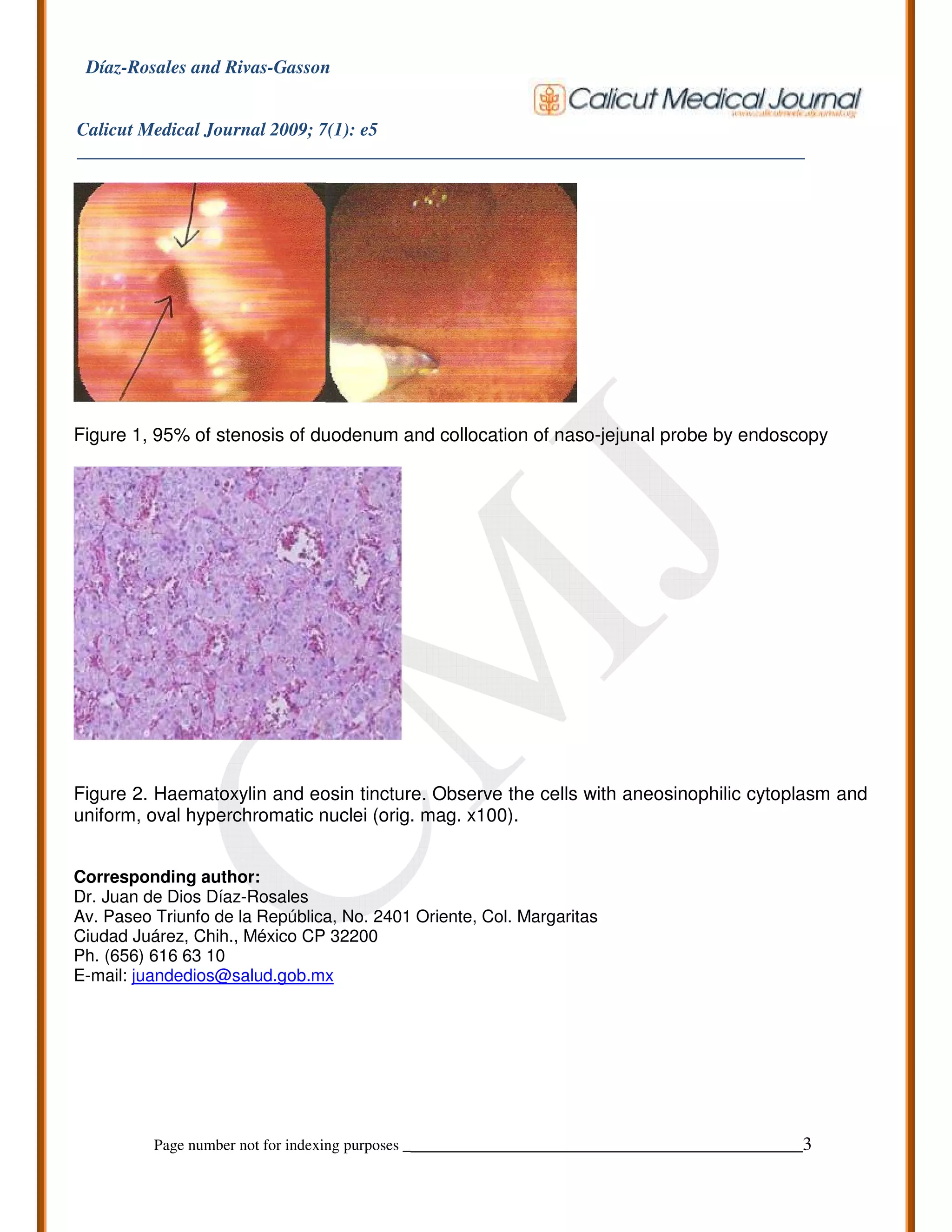 Carcinoid tumor in duodenum. Calicut Med J 2009 | PDF