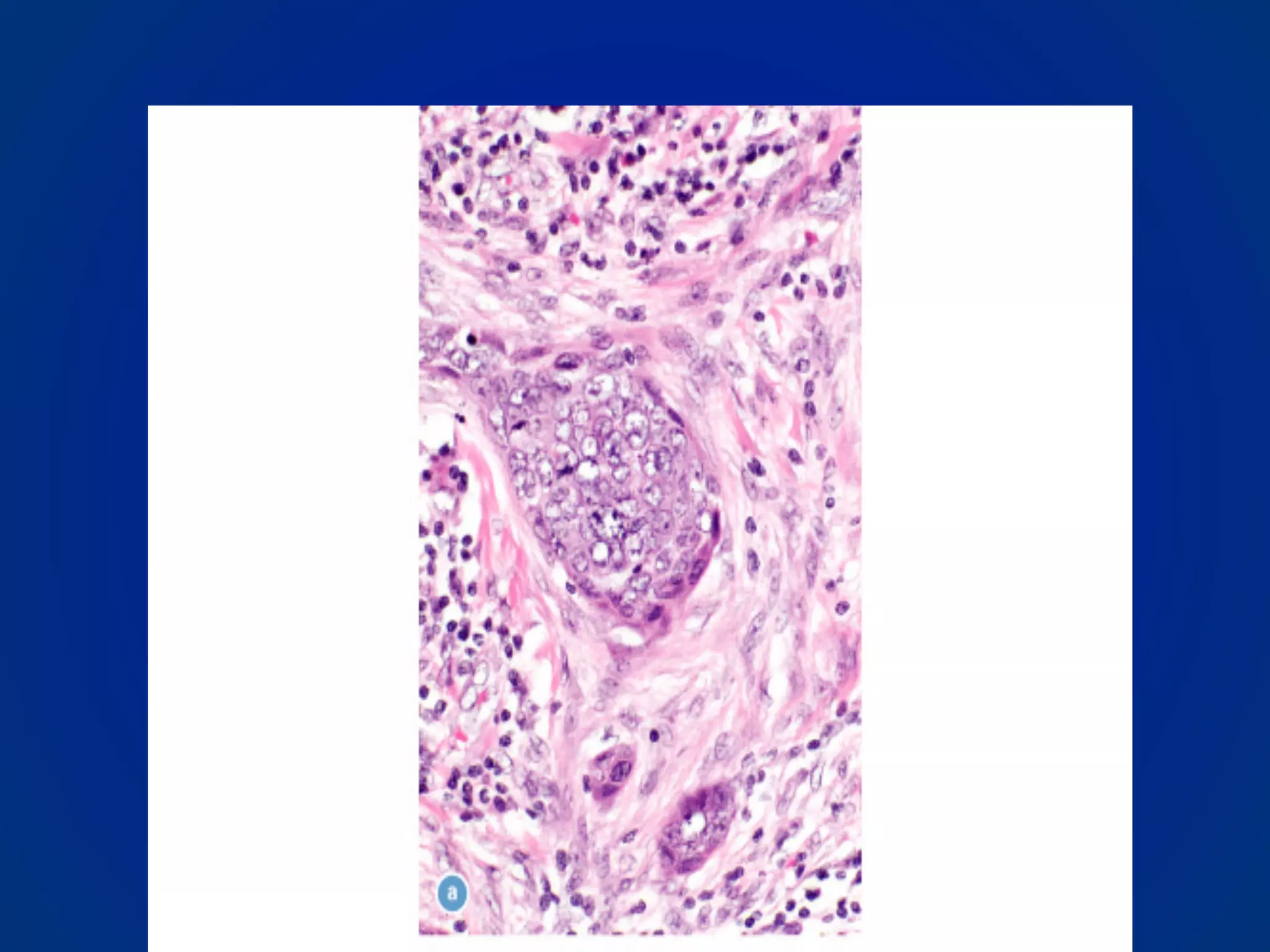 Carcinoma of cervix pathology | PDF
