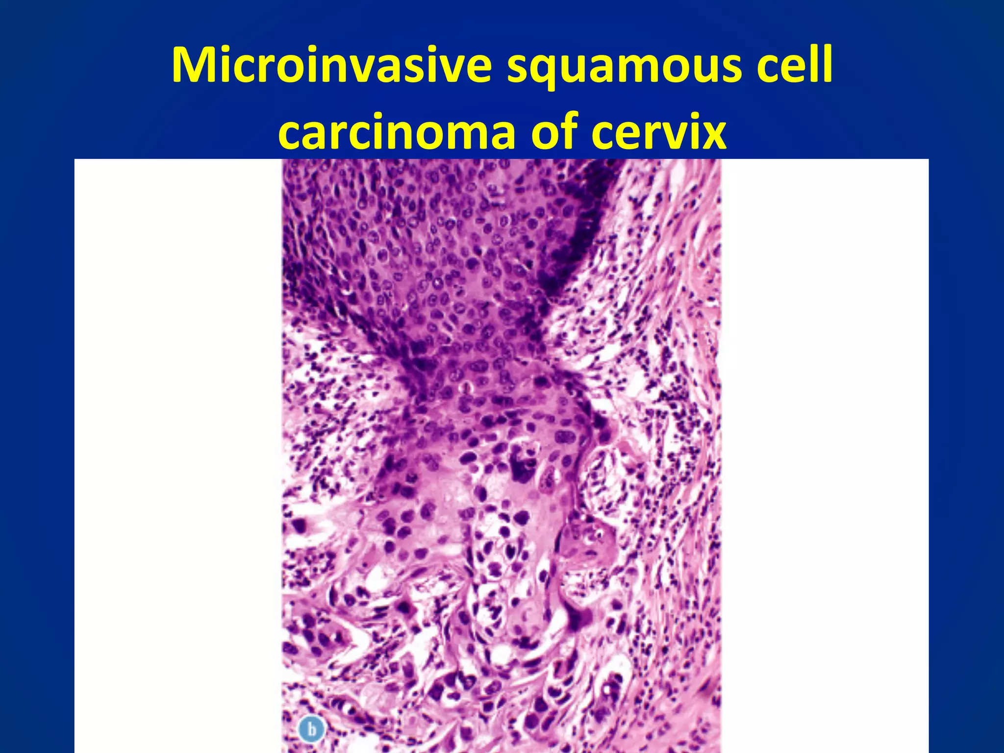 Carcinoma of cervix pathology | PDF