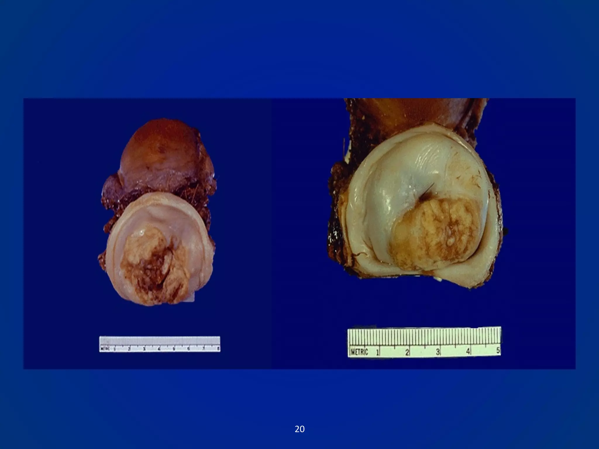Carcinoma of cervix pathology | PDF
