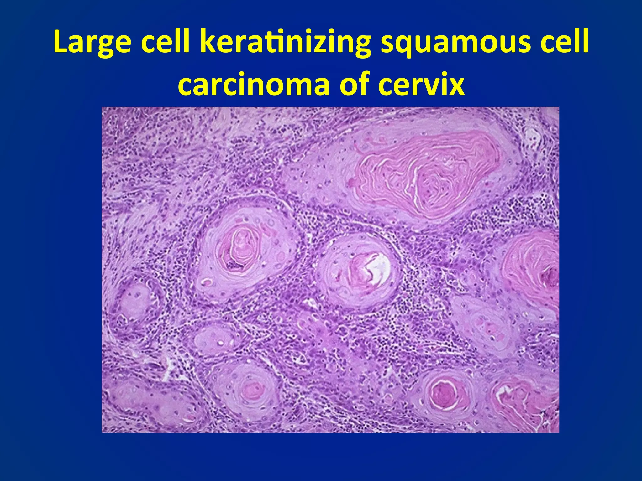 Carcinoma of cervix pathology | PDF