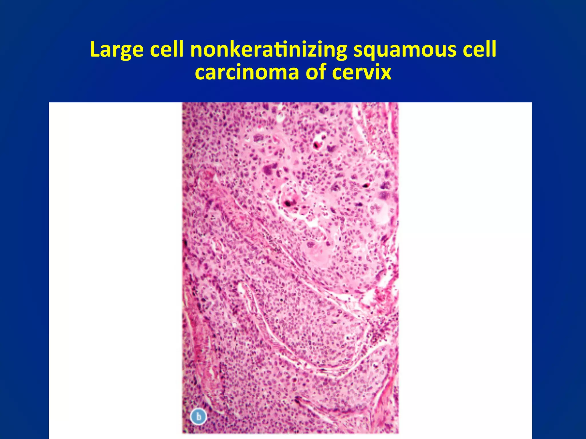 Carcinoma of cervix pathology | PDF