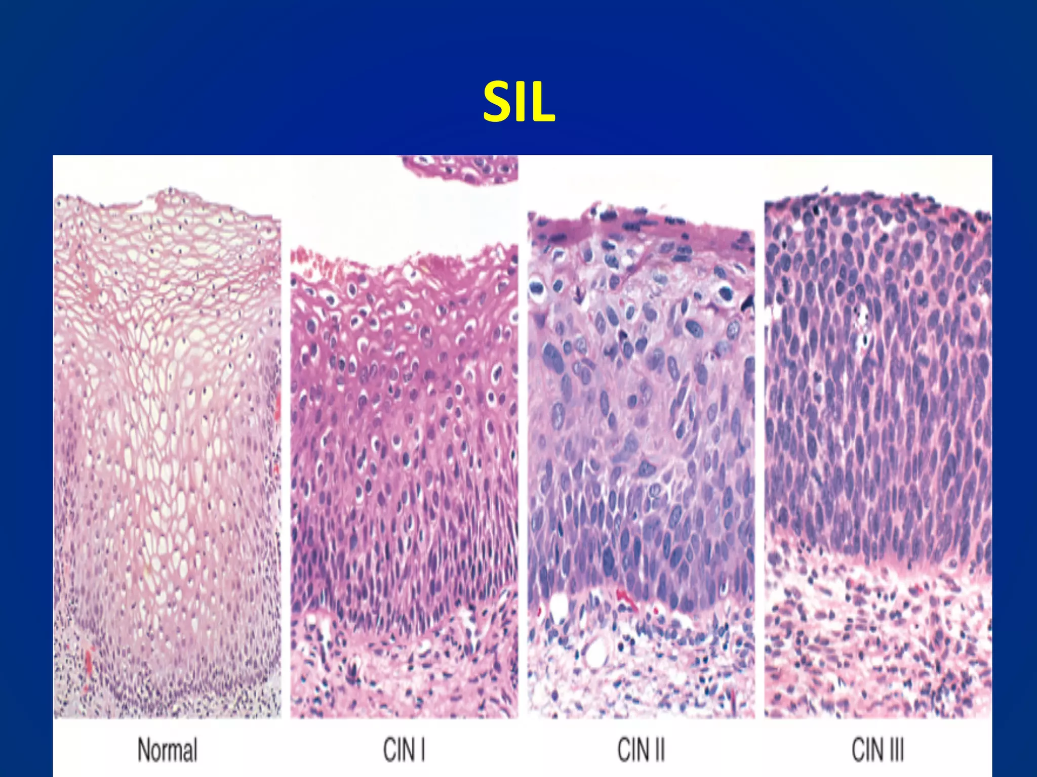 Carcinoma of cervix pathology | PDF