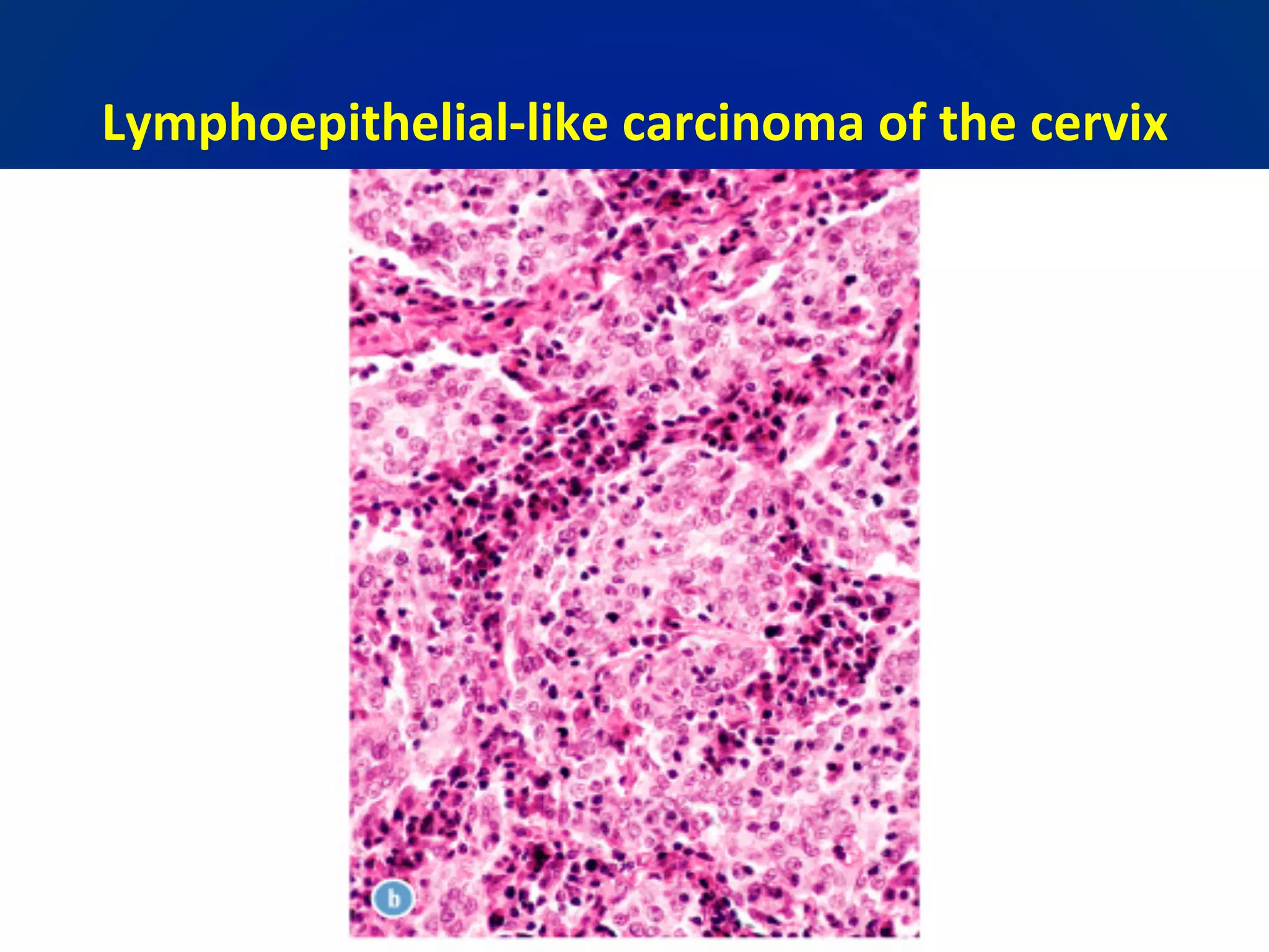 Carcinoma of cervix pathology | PDF