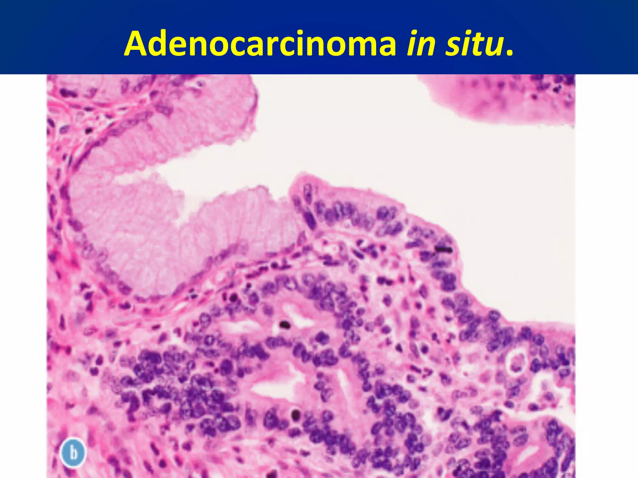 Carcinoma of cervix pathology | PDF
