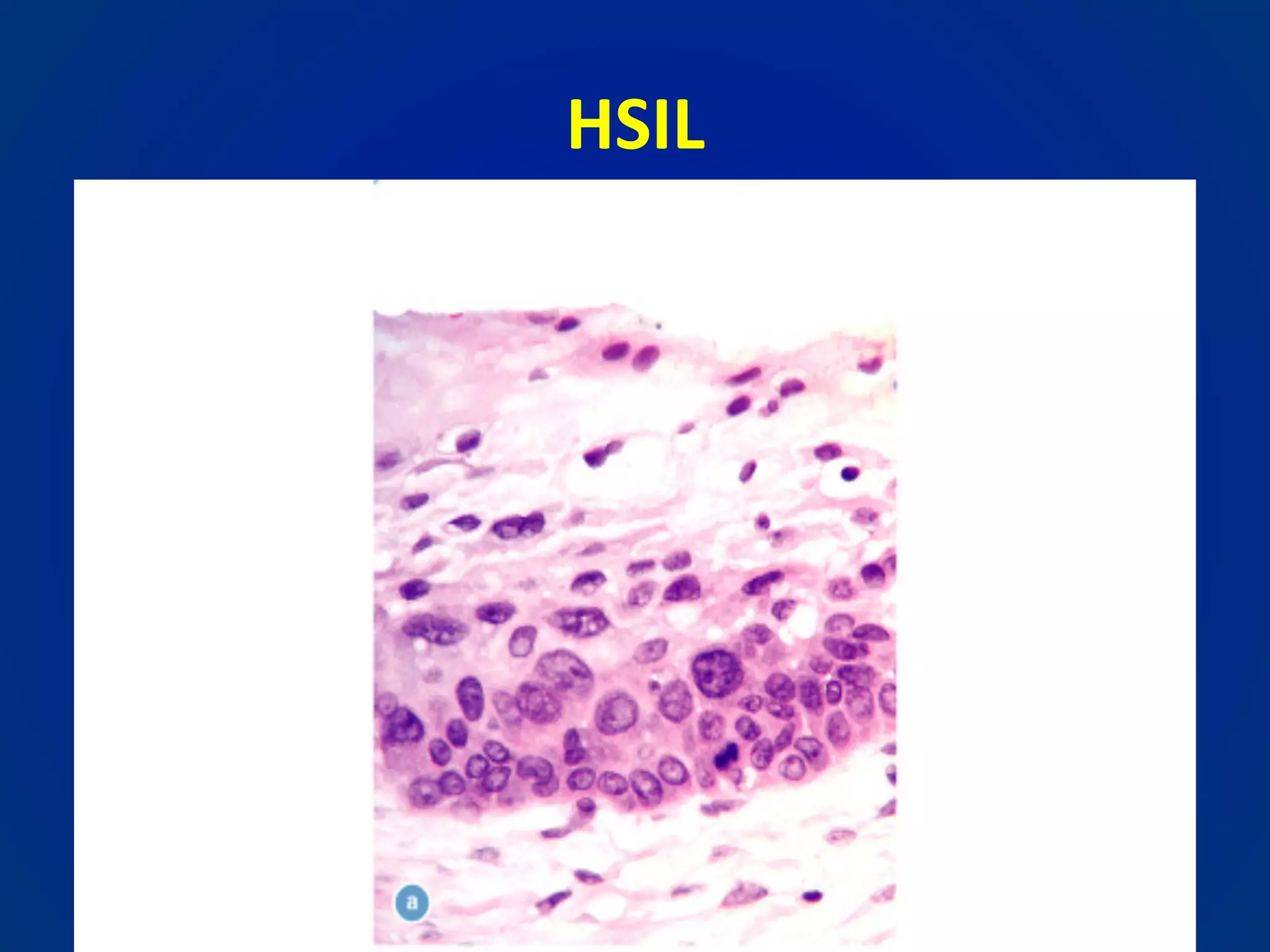 Carcinoma of cervix pathology | PDF