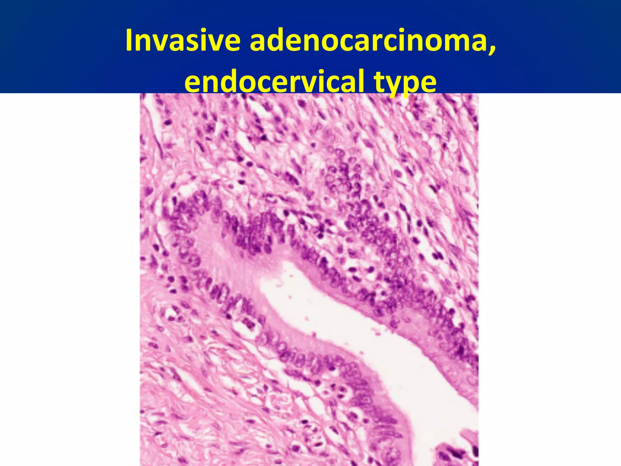 Carcinoma of cervix pathology | PDF