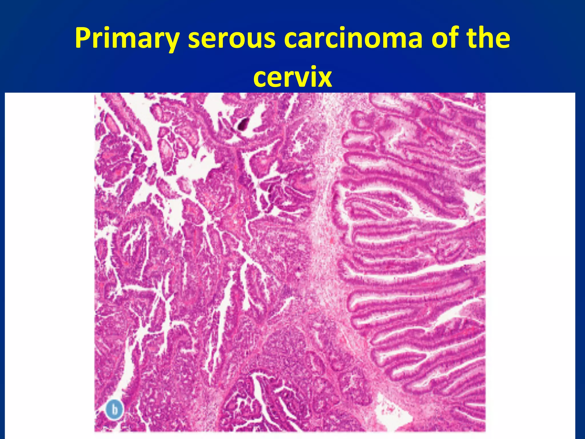 Carcinoma of cervix pathology | PDF
