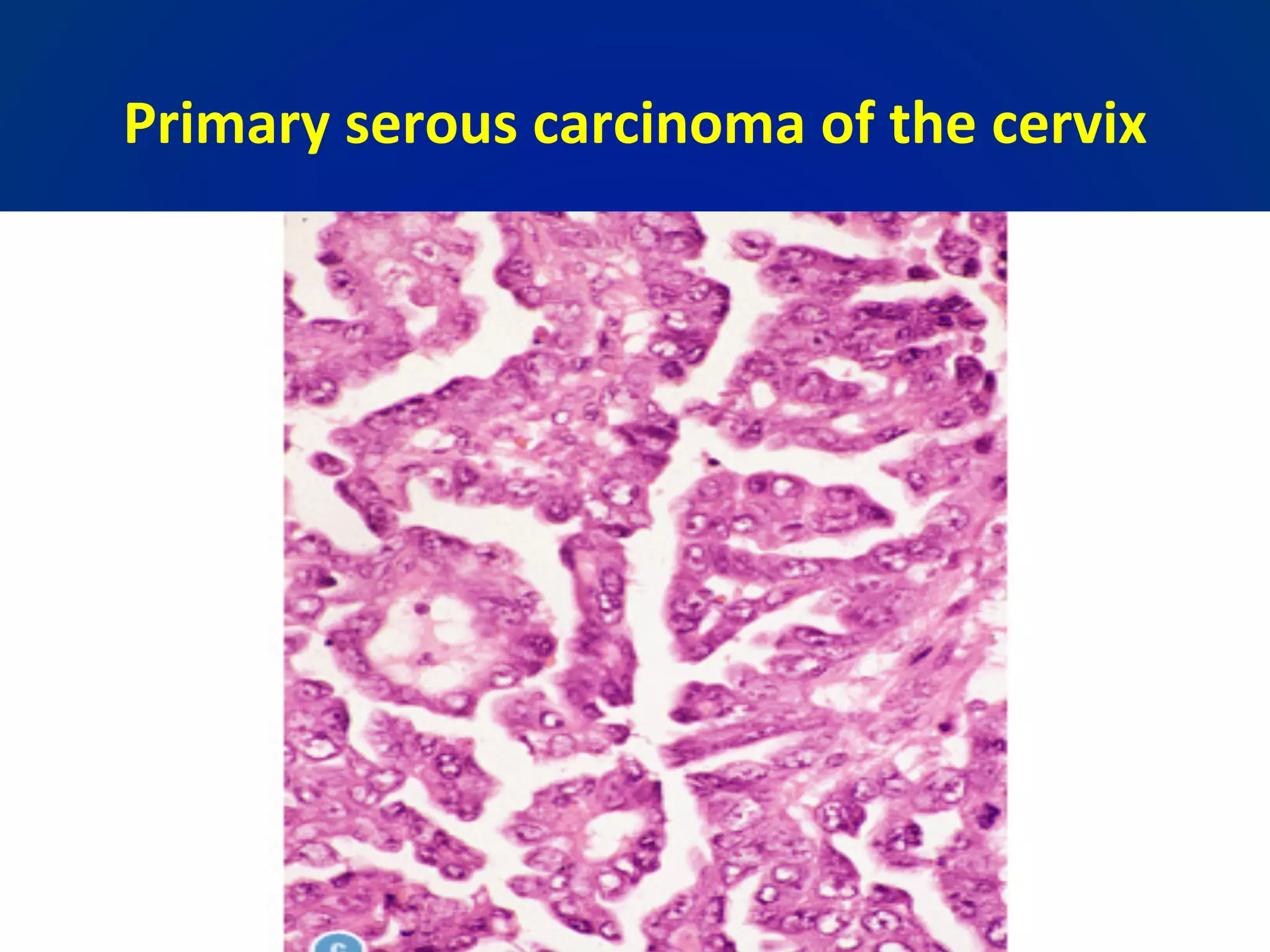 Carcinoma of cervix pathology | PDF