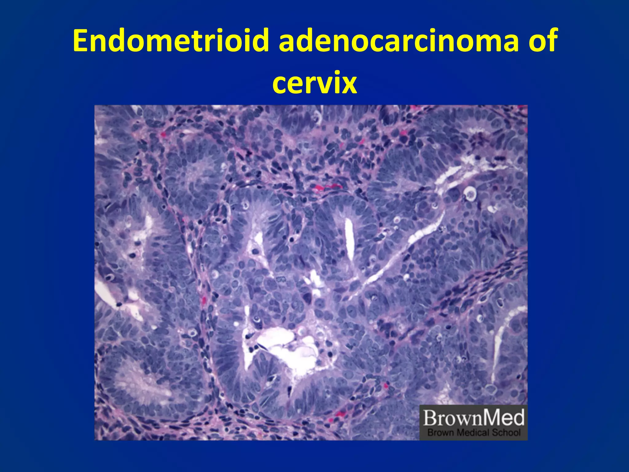 Carcinoma of cervix pathology | PDF
