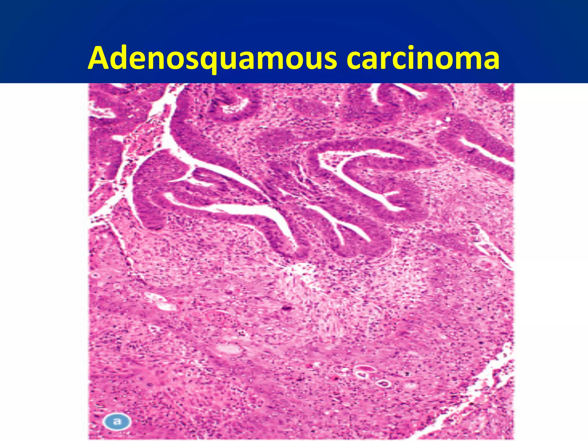 Carcinoma of cervix pathology | PDF