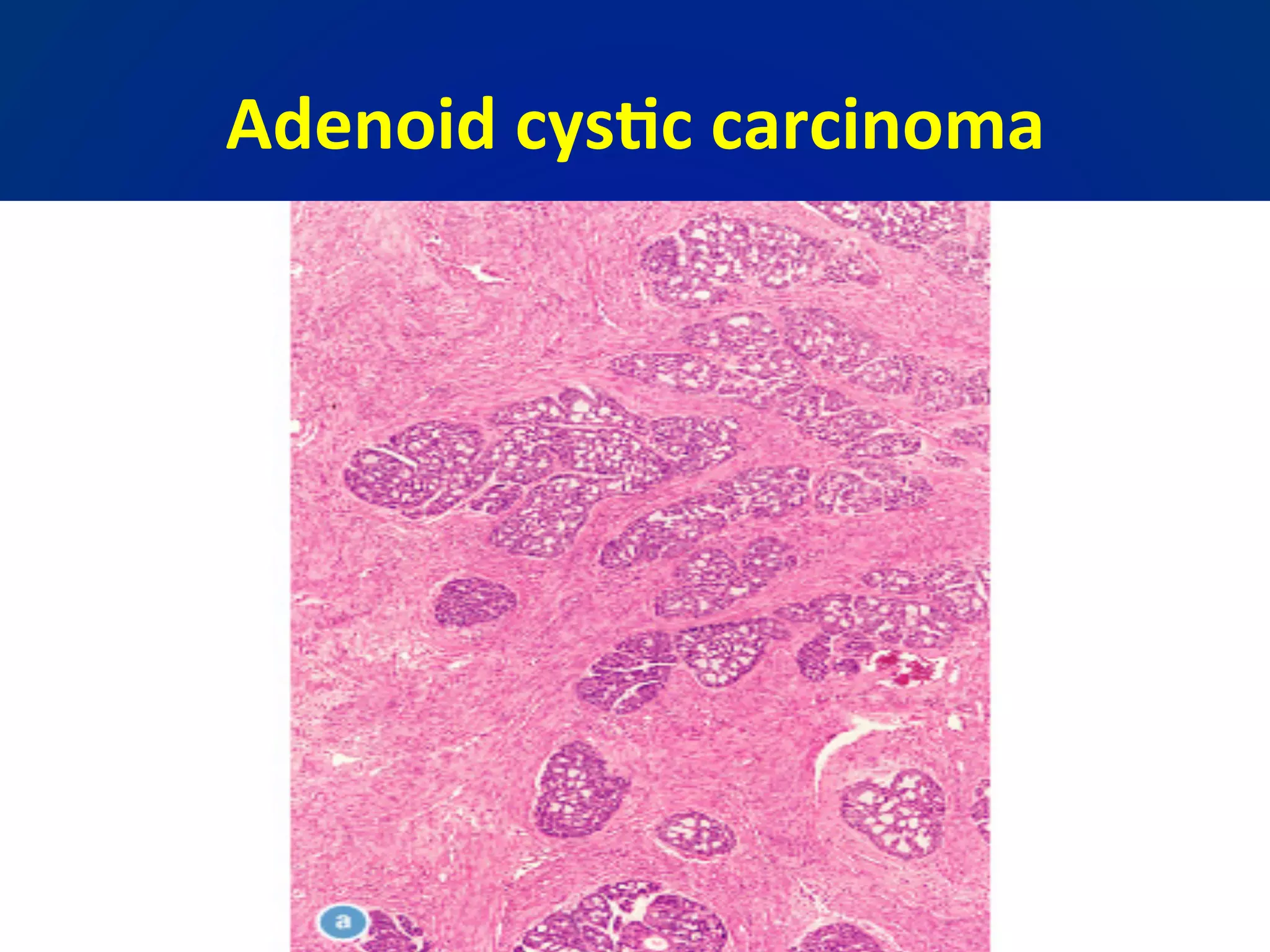 Carcinoma of cervix pathology | PDF