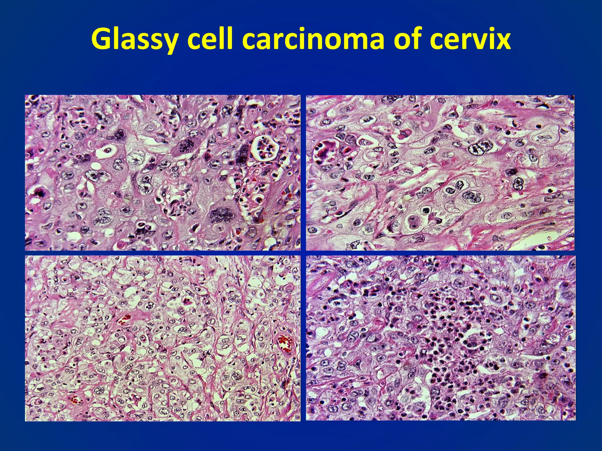 Carcinoma of cervix pathology | PDF