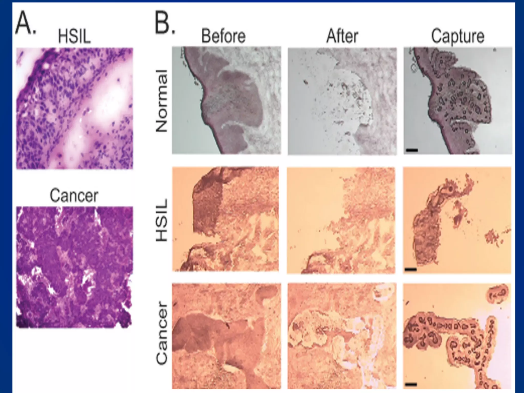 Carcinoma of cervix pathology | PDF