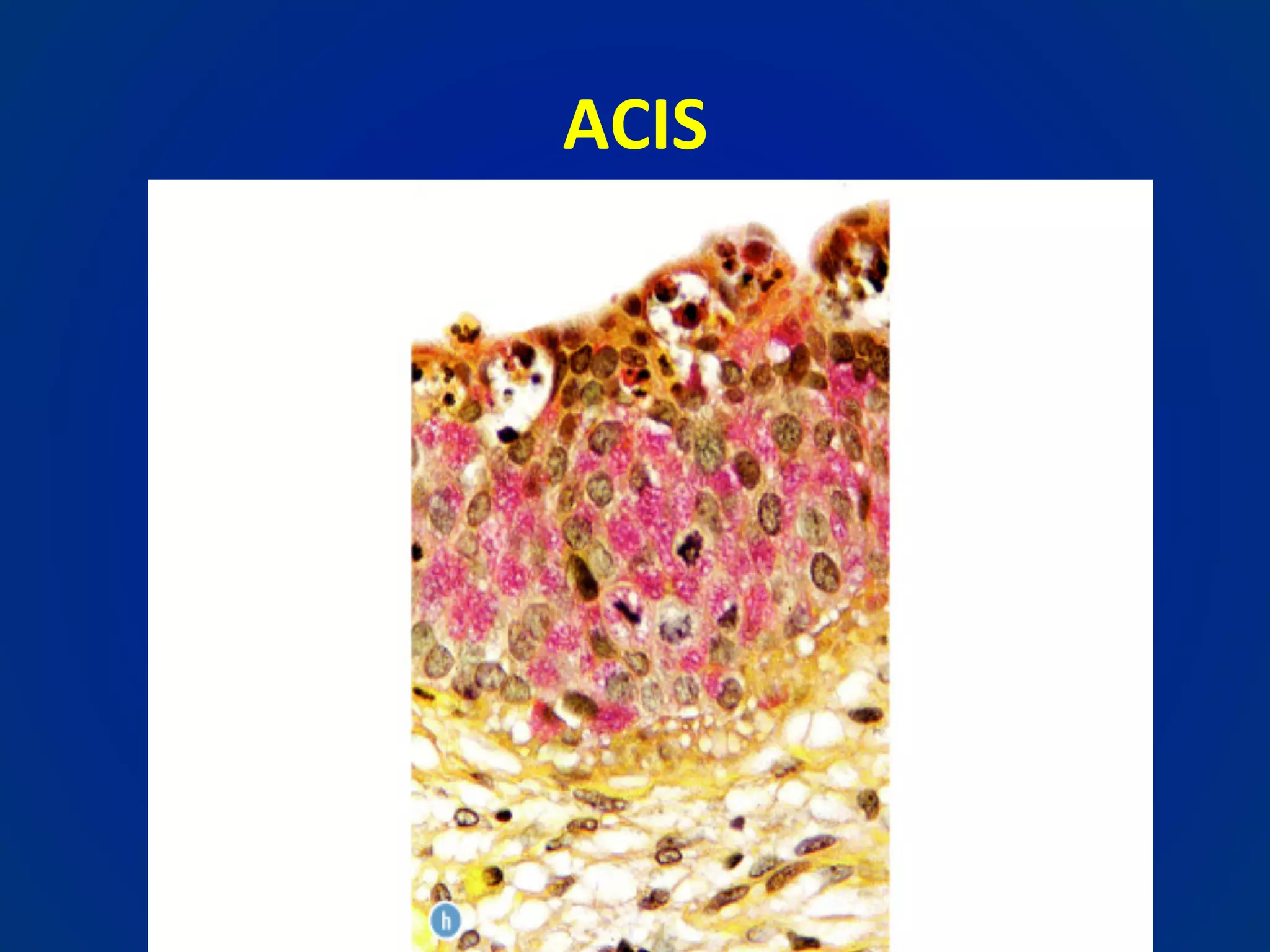Carcinoma of cervix pathology | PDF