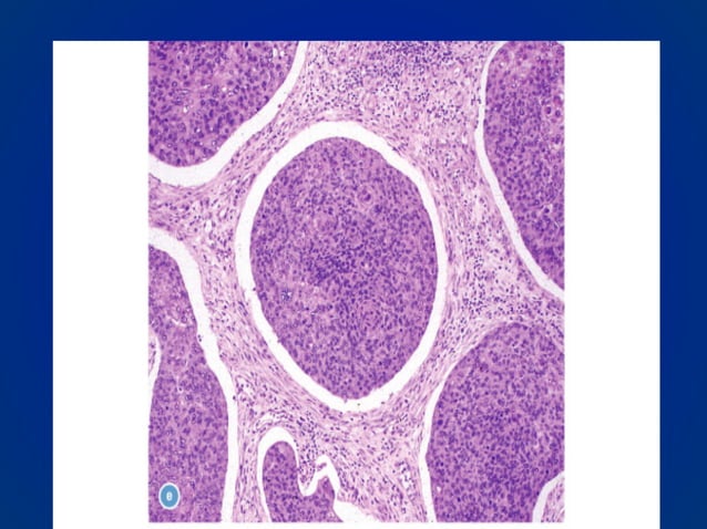 Carcinoma of cervix pathology | PDF