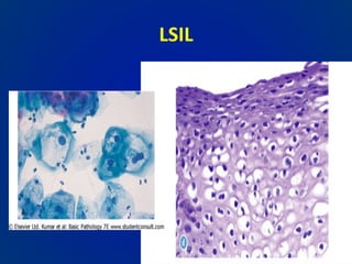 Carcinoma of cervix pathology | PDF