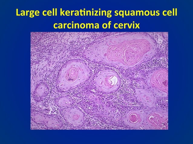 Carcinoma of cervix pathology | PDF