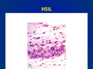 Carcinoma of cervix pathology | PDF