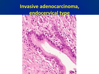 Carcinoma of cervix pathology | PDF