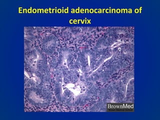 Carcinoma of cervix pathology | PDF