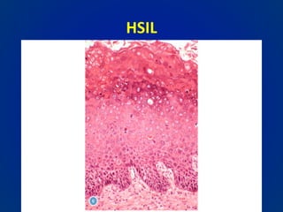 Carcinoma of cervix pathology | PDF