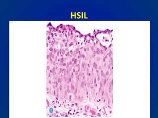 Carcinoma of cervix pathology | PDF