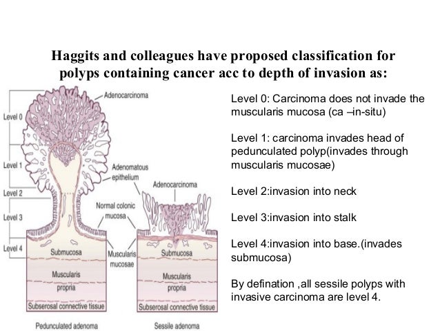 Carcinoma colon-and-management